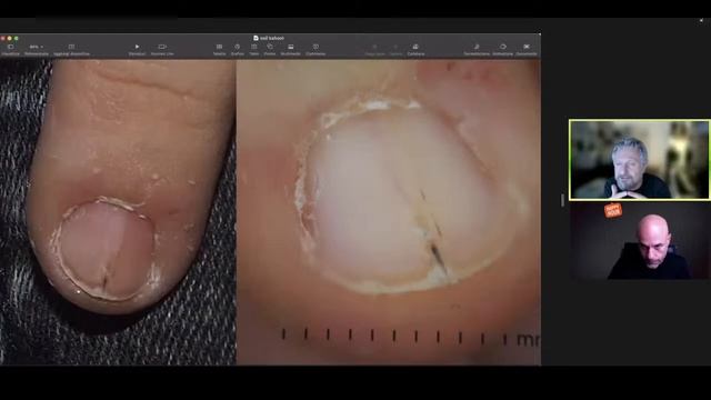 Ep.6 - DERMOSCOPY OF NAIL DISEASES with Michela Starace - Dermoscopy Happy Hour