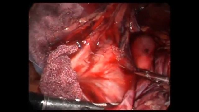 Клеевая трансабдоминальная преперитонеальная герниопластика