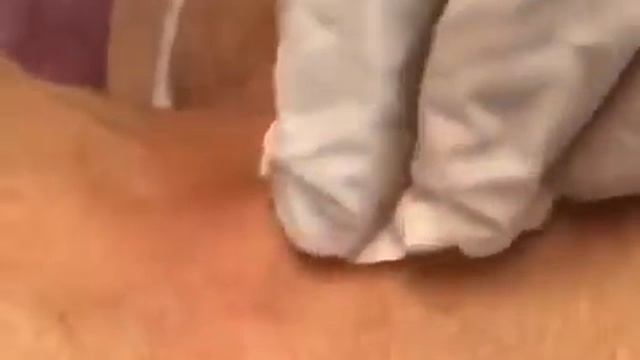 Хирургический кожный клей для фиксации сведенных краев ран после удаления липом