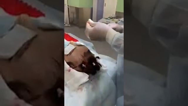 Применение кожного клея при фронто-темпоральном лифтинге