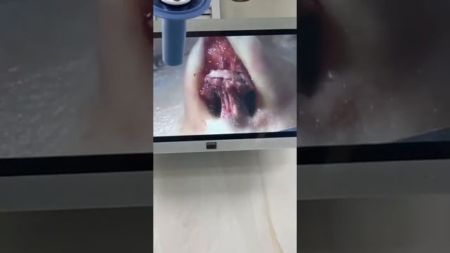 Ринопластика с применением биоклея