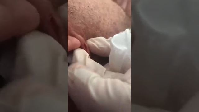 Удаление атером. Кожный клей вместо швов.