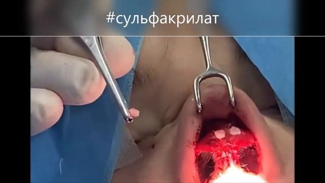 Опыт применения цианакрилатного клея в ринопластике