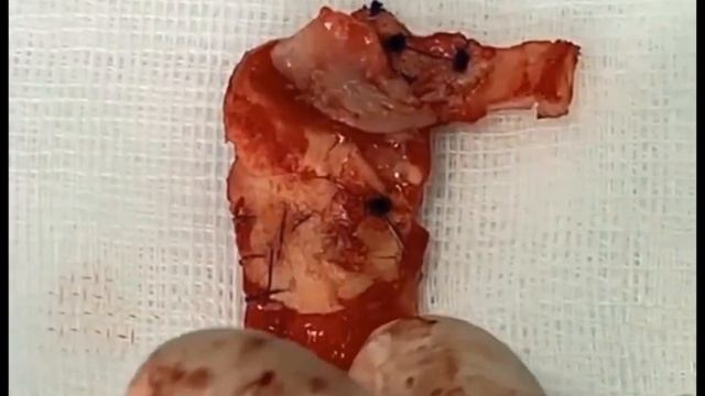 Реконструкция перегородки носа с помощью цианакрилатного клея