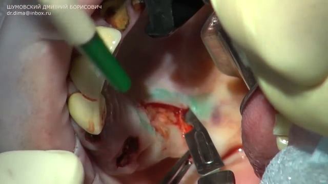 Фиксация гемостатической губки клеевым соединением.