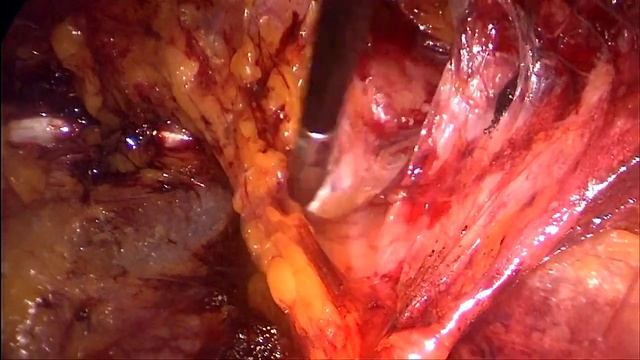 Фиксация полипропиленовой сетки медицинским клеем