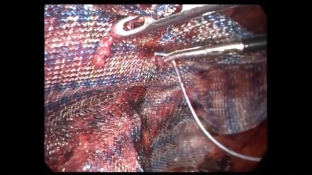 Проведение клеевой эндоскопической герниопластики