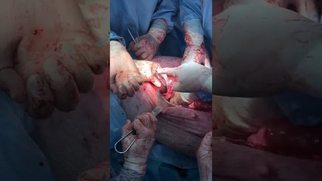 Остановка кровотечения из раны печени хирургическим клеем Сульфакрилат