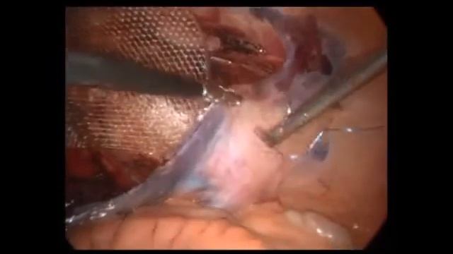 Использование хирургической клеевой композиции в герниопластике