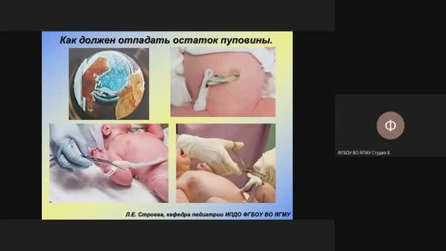 Как должен отпадать остаток пуповины? Доцент кафедры педиатрии ИПДО Строева Л.Е.
