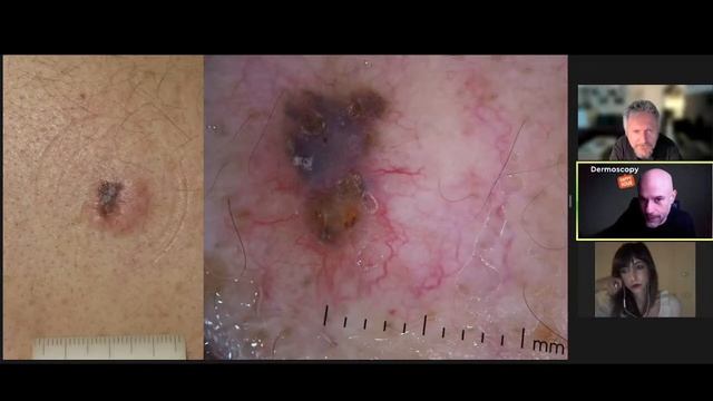 Ep.13 Melanocytic o not melanocytic with Elvira Moscarella - Dermoscopy Happy Hour