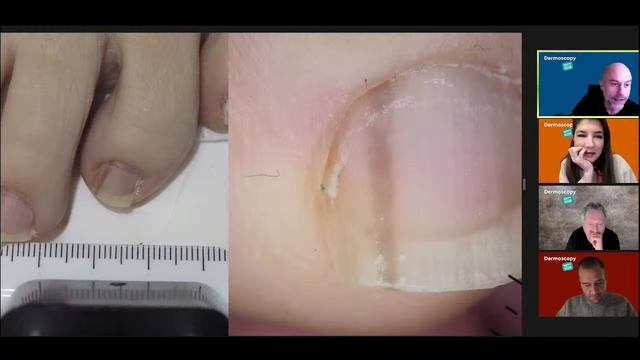 05. Dermoscopy Happy Hour - SEASON 2 EPISODE 5   NON PIGMENTED NAIL TUMORS