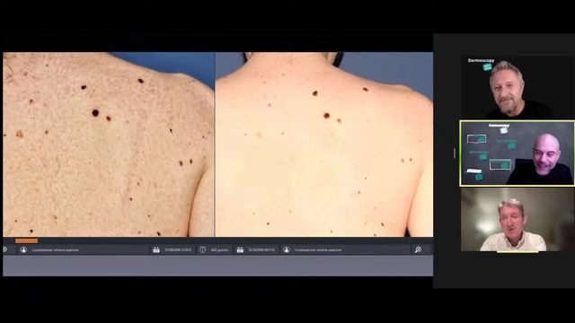 Ep.10 - DIGITAL MONITORING with Josep Malvehy  - Dermoscopy Happy Hour