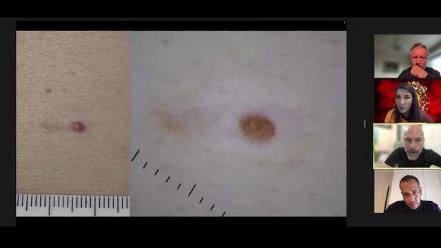 20. Dermoscopy Happy Hour - SEASON 2 EPISODE 20  LEARNING FROM MISTAKES