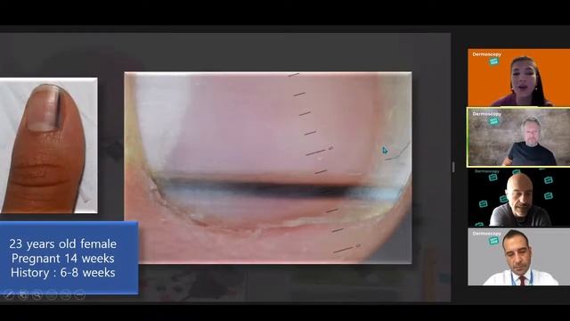 11. Dermoscopy Happy Hour - SEASON 2 EPISODE 11  MELANOMA IN PREGNANCY AND NEVI CHANGING IN PREGNANC