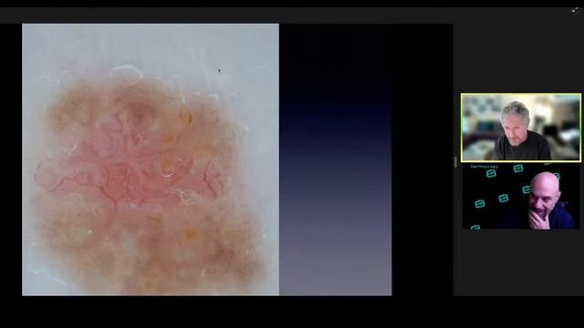 Ep. 19 -Collision Tumors with Nisa Akay - Dermoscopy Happy Hour