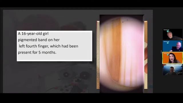 04. Dermoscopy Happy Hour - SEASON 2 EPISODE 4  MELANONYCHIA STRIATA