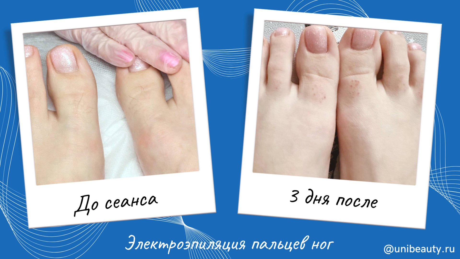 Электроэпиляция пальцев ног методом blend