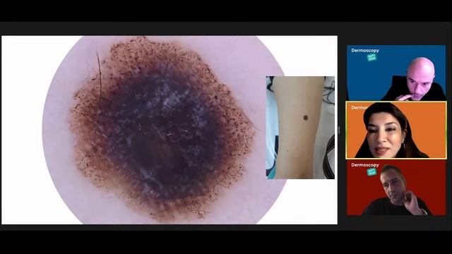 02. Dermoscopy Happy Hour - SEASON 2 EPISODE 2  Peripheral Globules