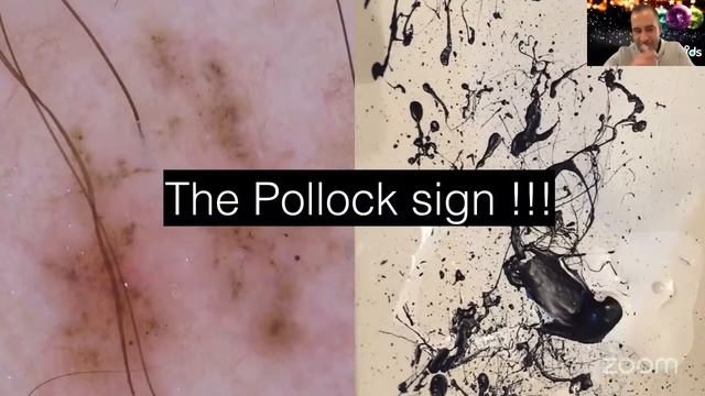 1. Dermoscopy Happy Hour - Ep.3 Season 4 - NICE METAPHORS!