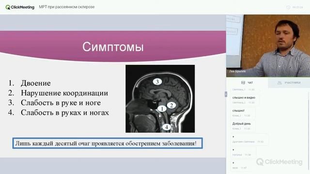 МРТ при рассеянном склерозе