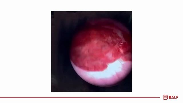 Уретеротомия