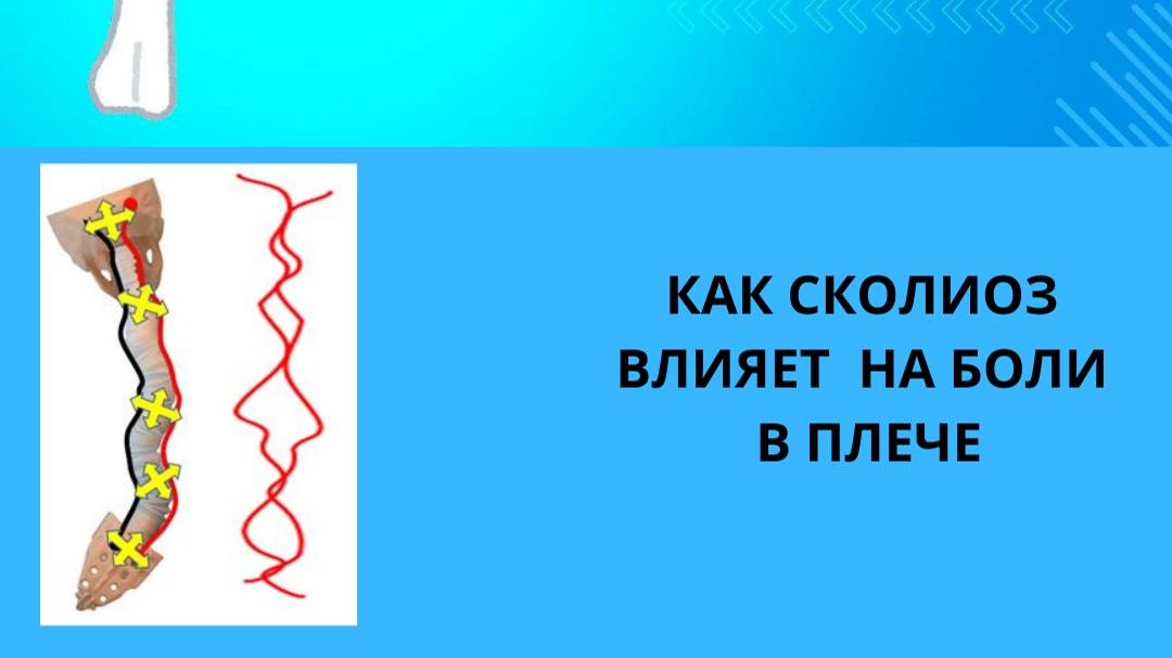 КАК ВЛИЯЕТ ПОЗВОНОЧНАЯ СПИРАЛЬ ГРИШИНА НА ВОЗНИКНОВЕНИЕ БОЛИ В ПЛЕЧЕ.