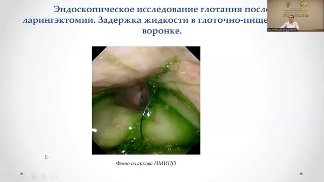 07. 5с. Исаева. Физиология акта глотания. Орофарингеальная дисфагия у пациентов с раком гортани