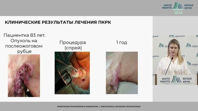 Криогенные технологии в лечении больных с опухолями кожи / #WNOF2024