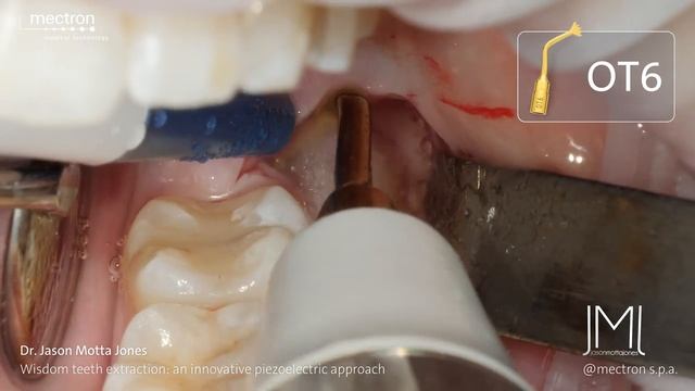 Пьезохирургический  метод удаления зубов мудрости