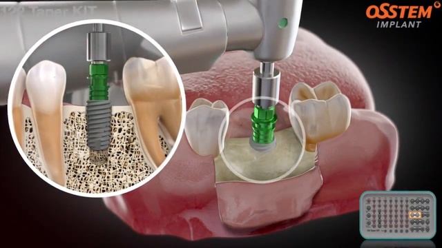 122 Taper Kit Протокол