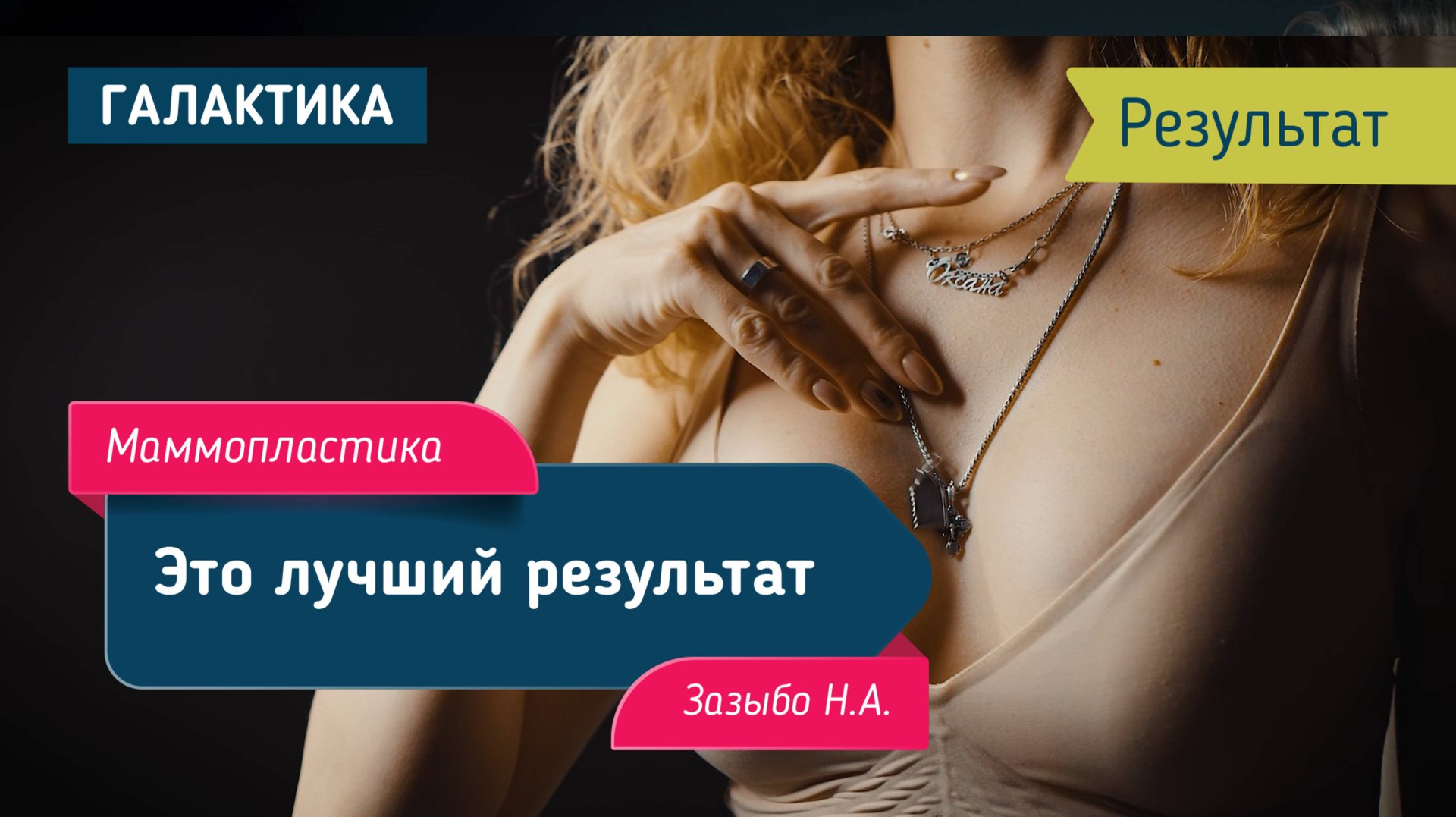 Результат после маммопластики, через 7 месяцев | Зазыбо Николай Александрович