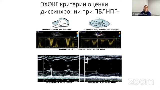 Основы СРТ: критерии ответа на терапию, оптимизация СРТ и ЭКГ интерпретация