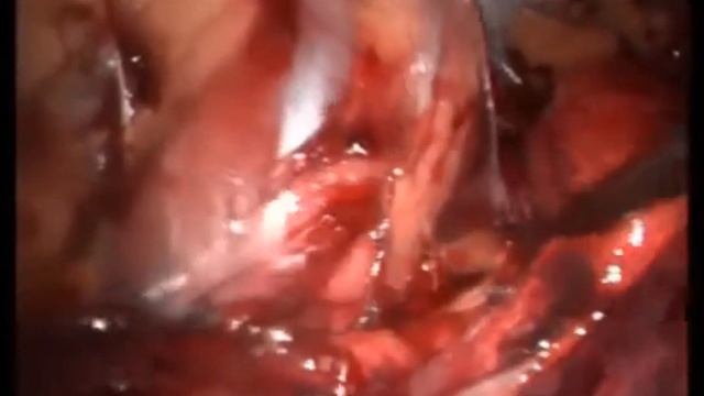 Фиксация полипропиленового протеза отечественной клеевой композицией при Solo-eTEP