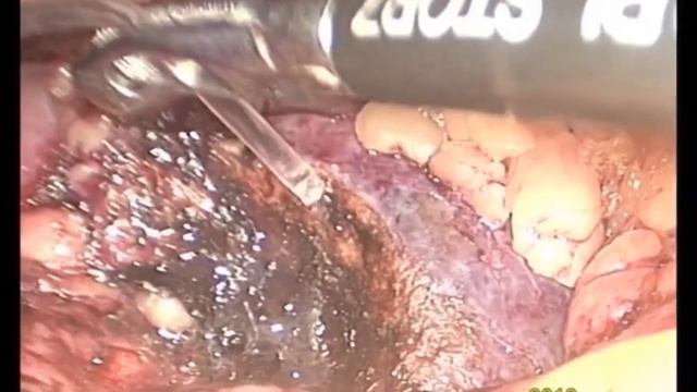 Применение хирургического клея при резекции почки ЛООД