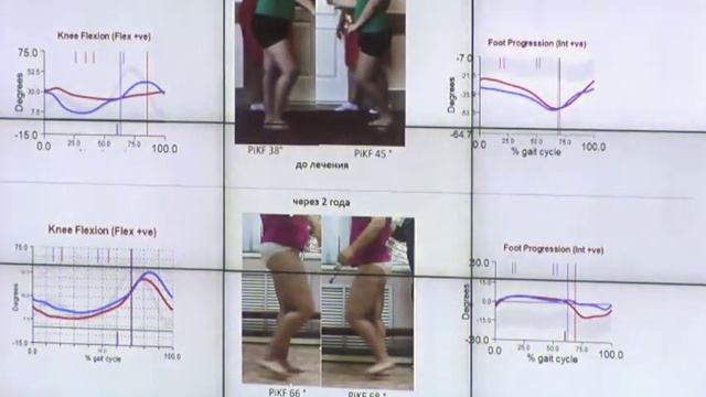 Диагностика и хирургическое лечение ортопедических осложнений ДЦП
