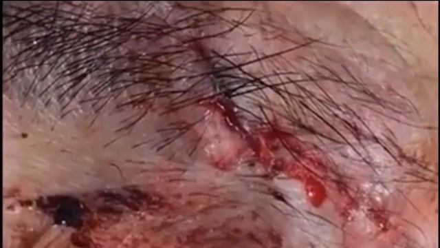 Склеивание рассеченной раны в травмпункте