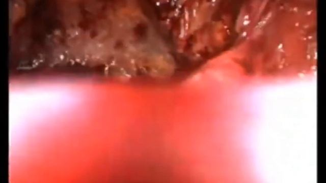 еТЕР  при паховой грыже с применением хирургической клеевой композиции.