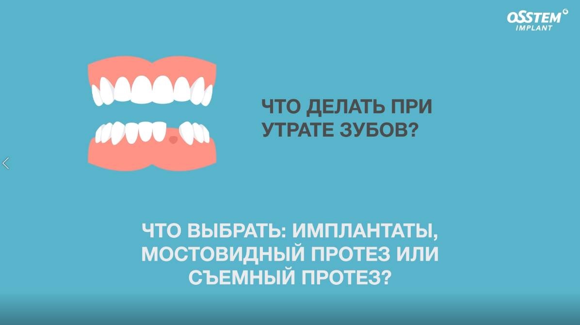 Что выбрать: имплантаты или протезы
