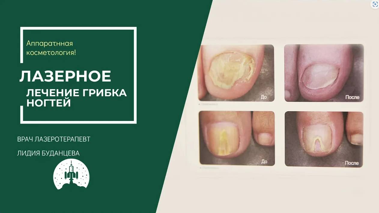 Лазерное лечение грибка ногтей