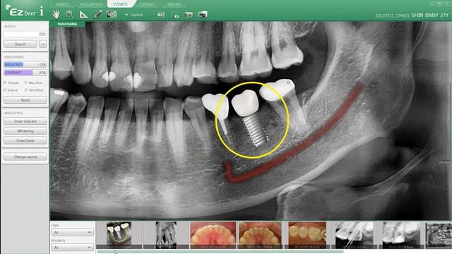 Программное обеспечение EzDent-i от Vatech