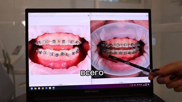 Вместе с врачом ортодонтом Анастасией Романовной, вы увидите процесс лечения на брекетах