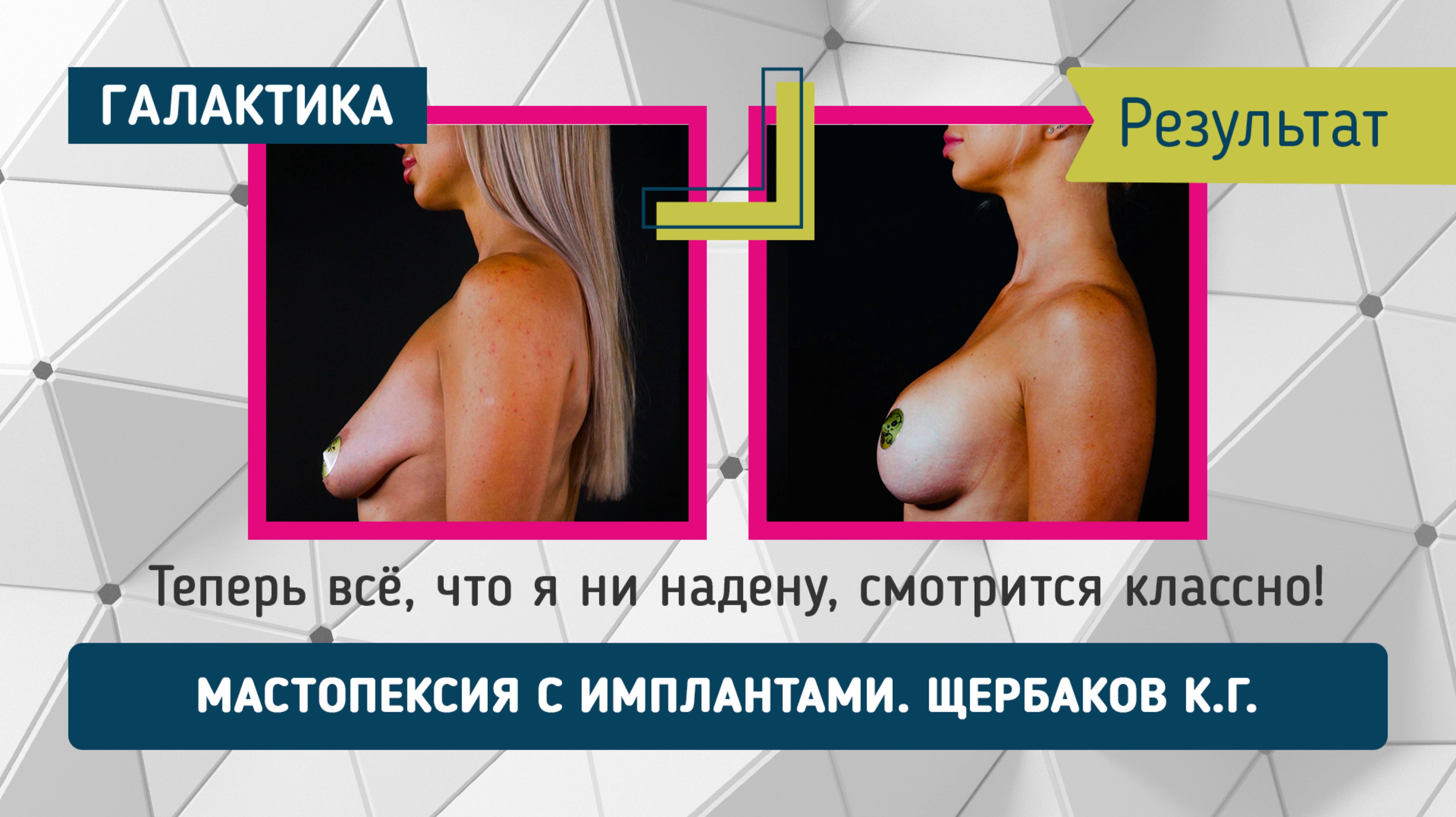 Проект "Оморфия" мастопексия с имплантами |  Щербаков Кирилл Геннадьевич
