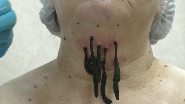 Гирудотерапия + плазмотерапия при коррекции овала лица и мимических морщин. Фрагмент вебинара