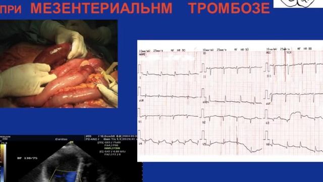 Инфаркт миокарда дифдиагностика и маски инфаркта Кошкина Е. В.