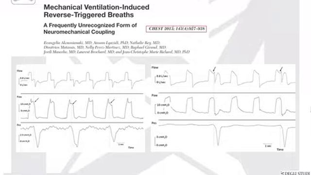 Patient ventilator interaction during assisted mechanical ventilation G Bellani