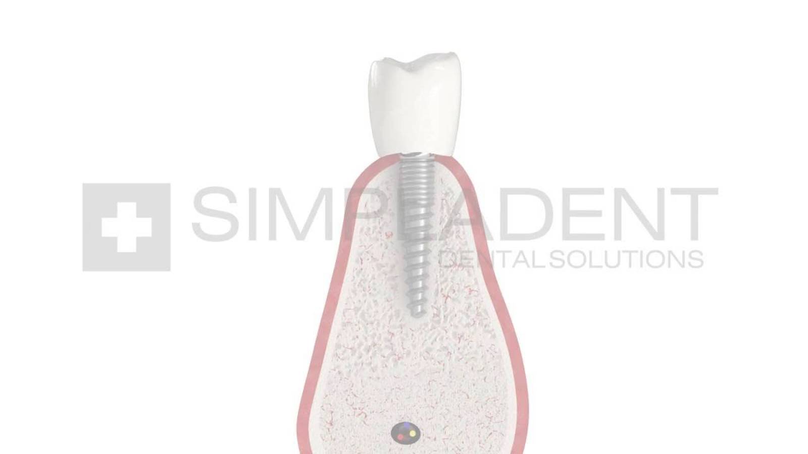 Двухэтапная имплантация с отсроченной нагрузкой  Simpladent Симпладент