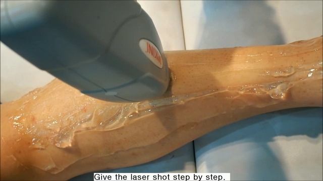 VIKINI_Operation проведение процедуры