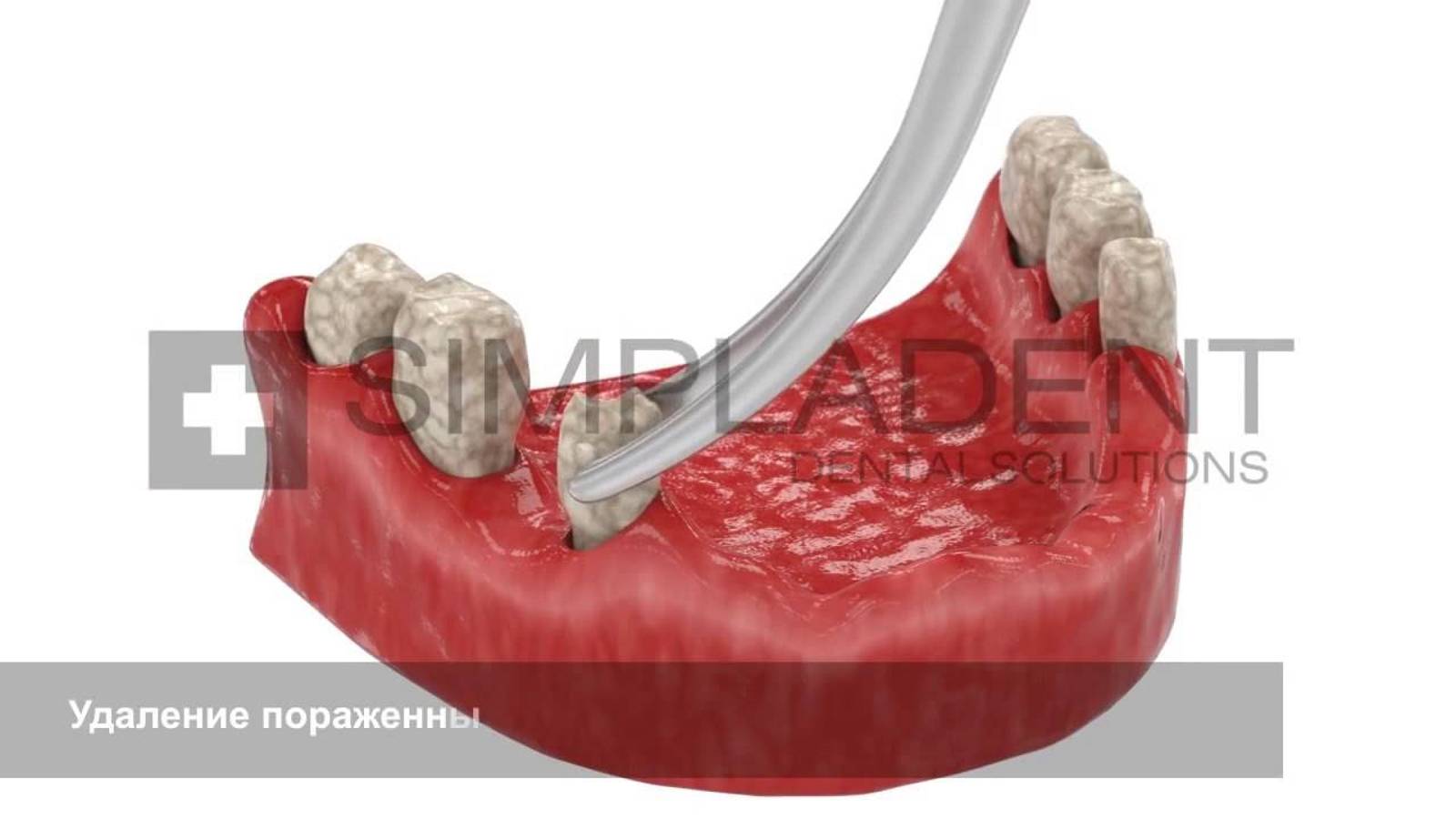 Наглядно: как происходит имплантация зубов при запущенном пародонтите. Simpladent. Симпладент.