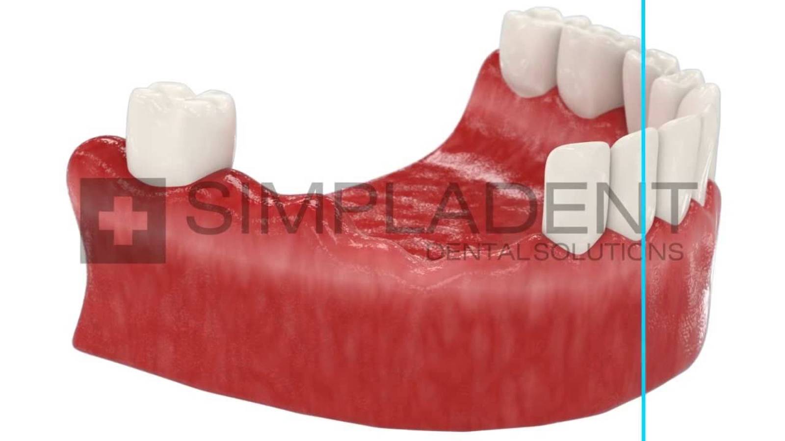 Как происходит имплантация жевательных зубов с немедленной нагрузкой за 4 дня. Simpladent Симпладент